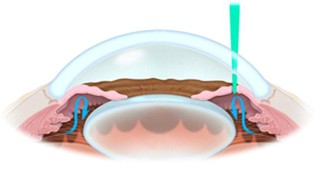 Laser PI | Eye & Glaucoma Surgeons