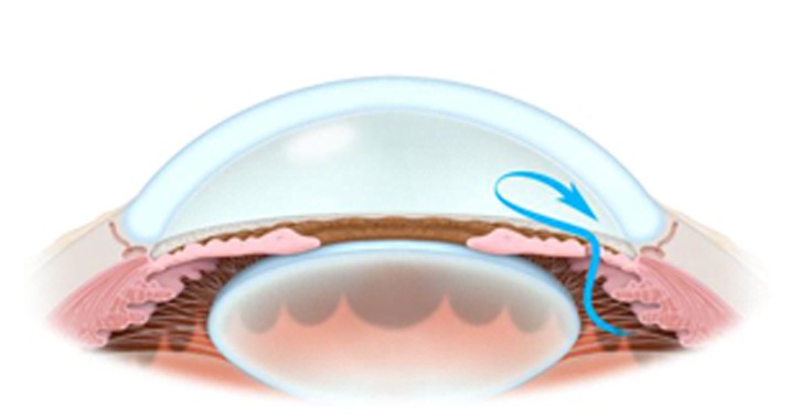 Laser PI | Eye & Glaucoma Surgeons
